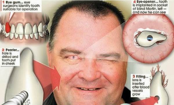 IAN TIBBETTS RECUPERA LA VISION GRACIAS A SU DIENTE | Veamos Una De ...