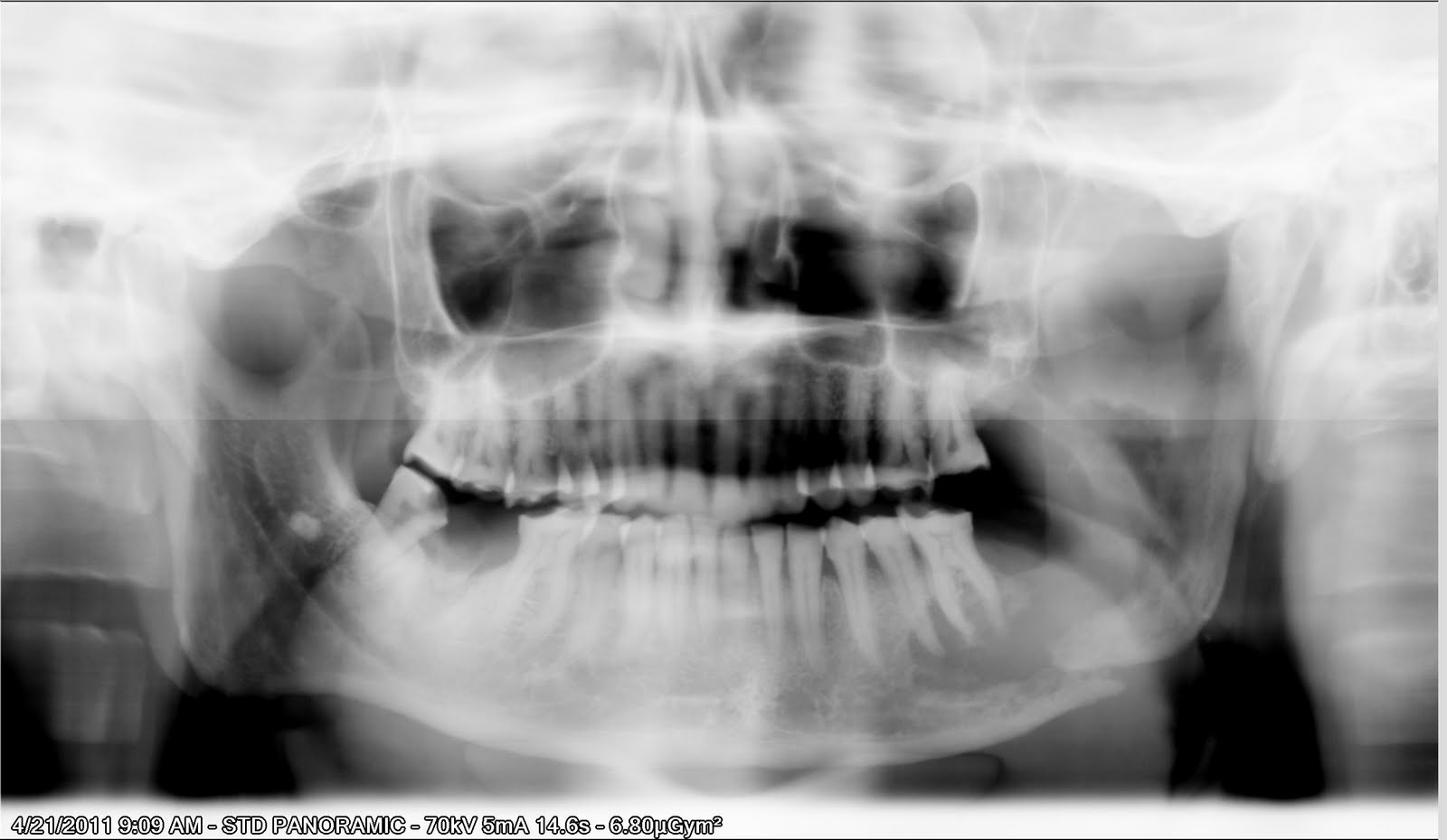 oral medicine and radiology: progressing malignancy and its effect on ...
