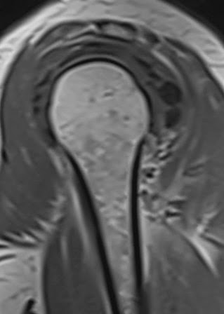 RADIODIAGNOSIS - IMAGE COLLECTION: MILWAUKEE SHOULDER