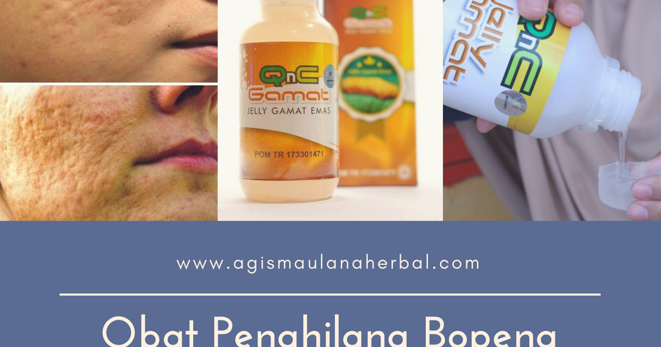 OBAT PENGHILANG BOPENG BEKAS JERAWAT BERLUBANG DI apotik