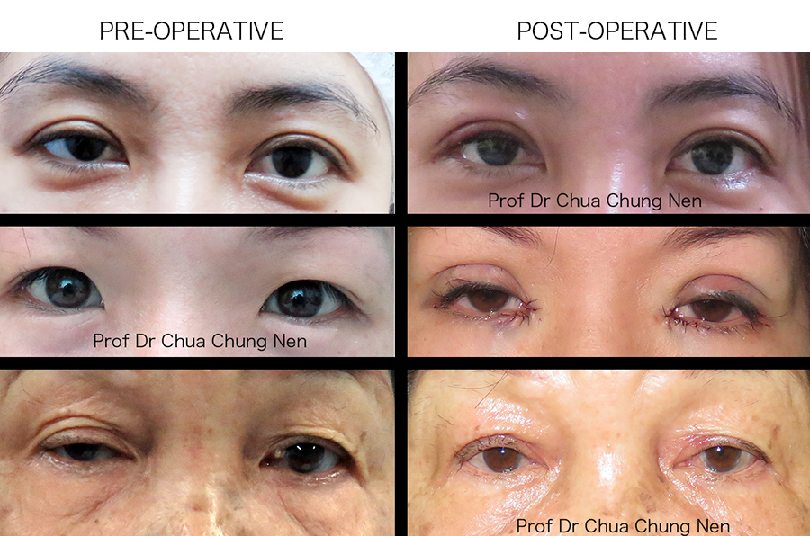 Eyelid Surgery by Prof Dr CN CHUA 蔡鐘能: Postoperative Review