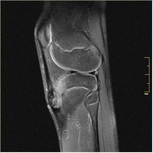 Osgood Schlatter Disease Mri