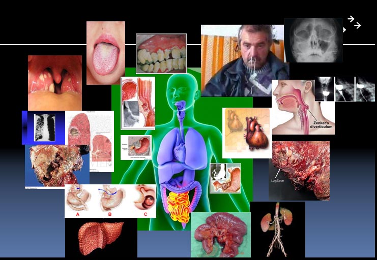 HálitoGastro: Halitose: como abordar o paciente e como tratá-lo PARTE 1