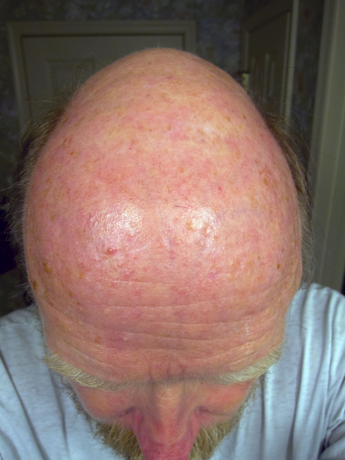 Efudex - Round Two: January 2012