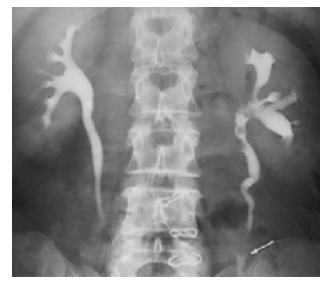 Những thắc mắc quanh Chụp niệu đồ tĩnh mạch - UIV | Bác Sĩ Đa Khoa