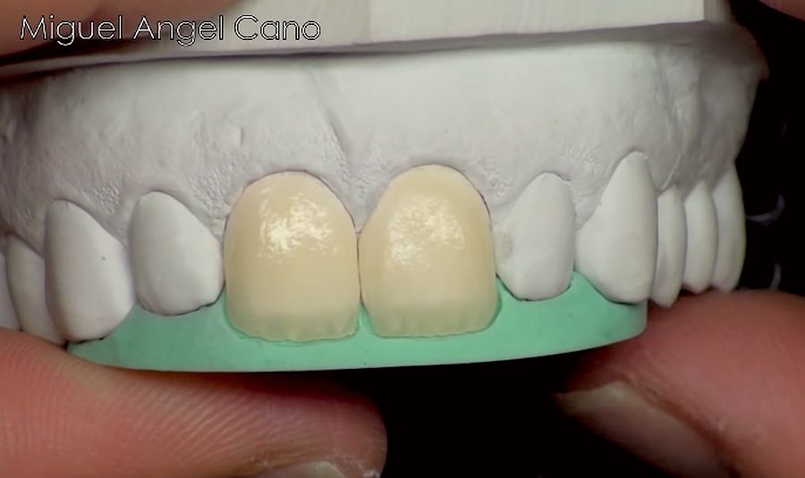 CARILLAS DENTALES de cerámica paso a paso - Odonto-Tv