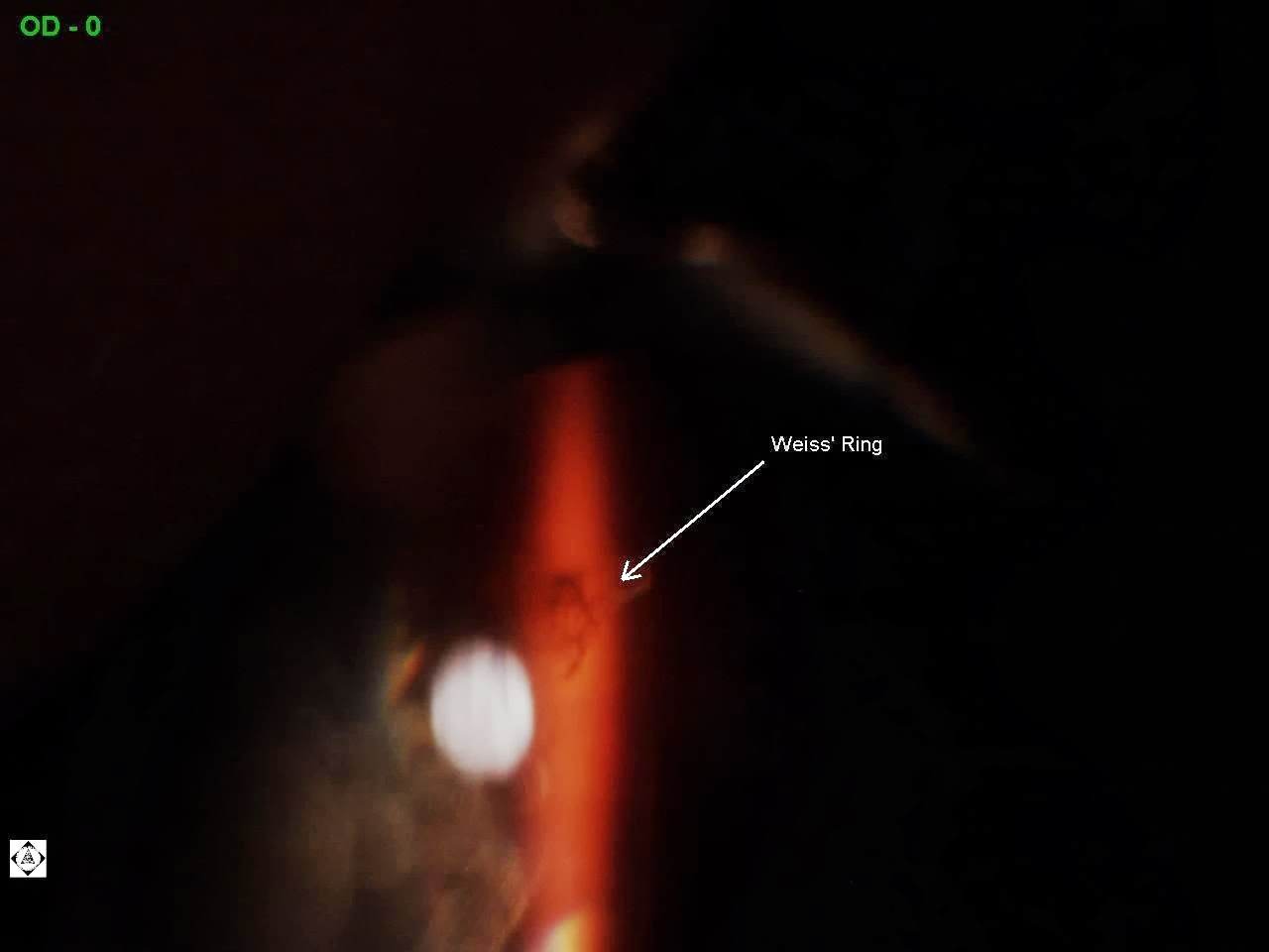 Sonoran Desert Eye Center: WEISS' RING FROM POSTERIOR VITREOUS ...