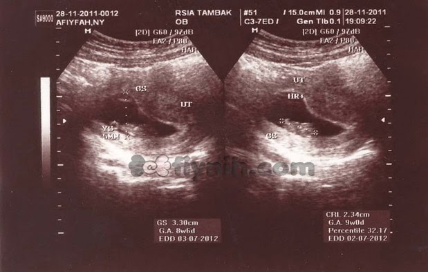 Bagaimana Cara Membaca Hasil Foto Usg - breadelectro