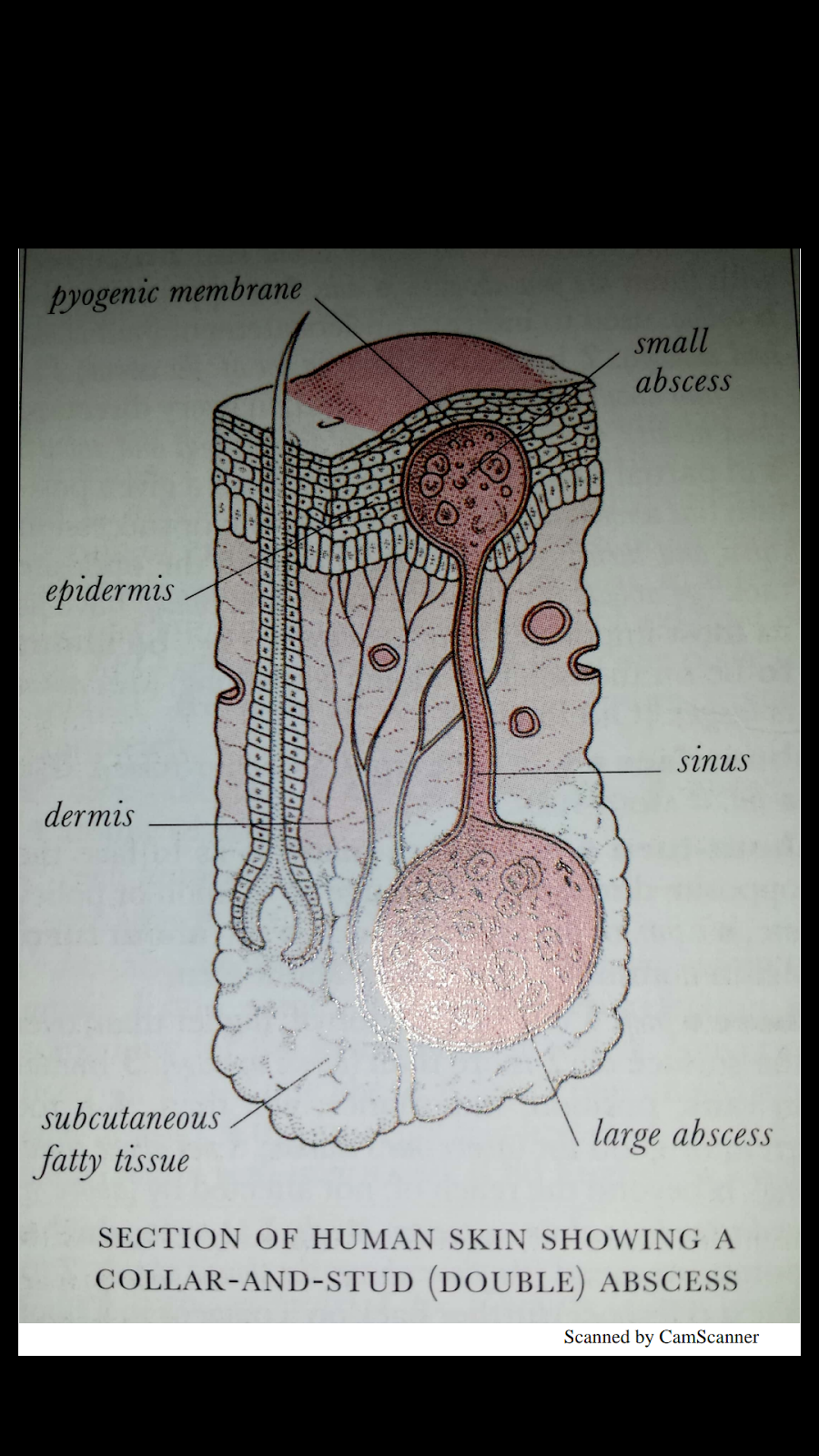 Human Body structure: ABSCESS