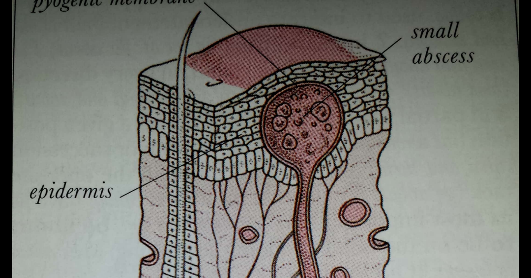 Human Body structure: ABSCESS