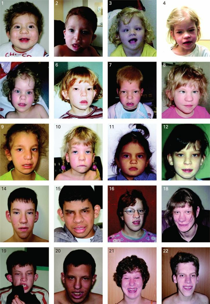 Paperless clinical genetics blog: Face2Gene and syndrome recognition by ...
