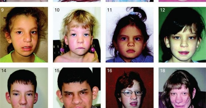 Paperless clinical genetics blog: Face2Gene and syndrome recognition by ...