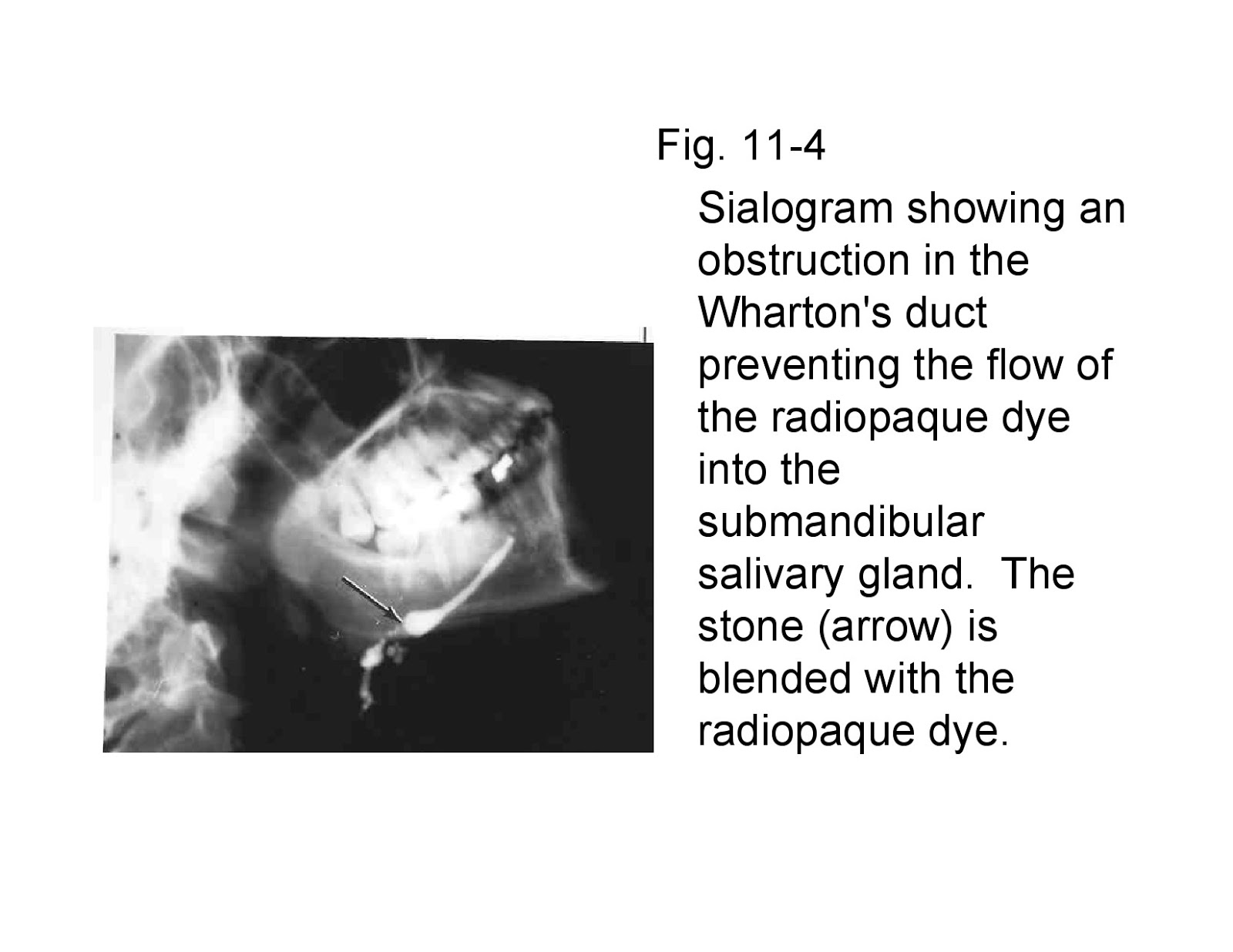 Dentistry and Medicine: SOFT TISSUE CALCIFICATIONS IN ORO-MAXILLO ...
