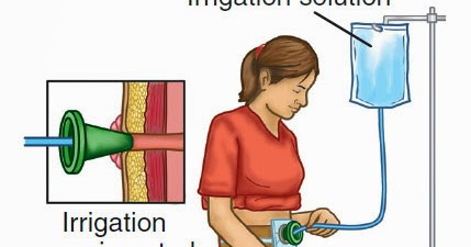 Procedure of Irrigating a Colostomy ~ Nursing