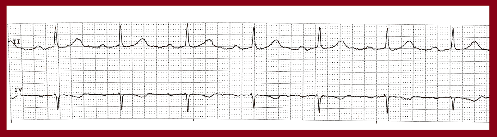 Practice EKG Strips 319