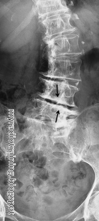 Radiology info hub: Modic changes in MRI