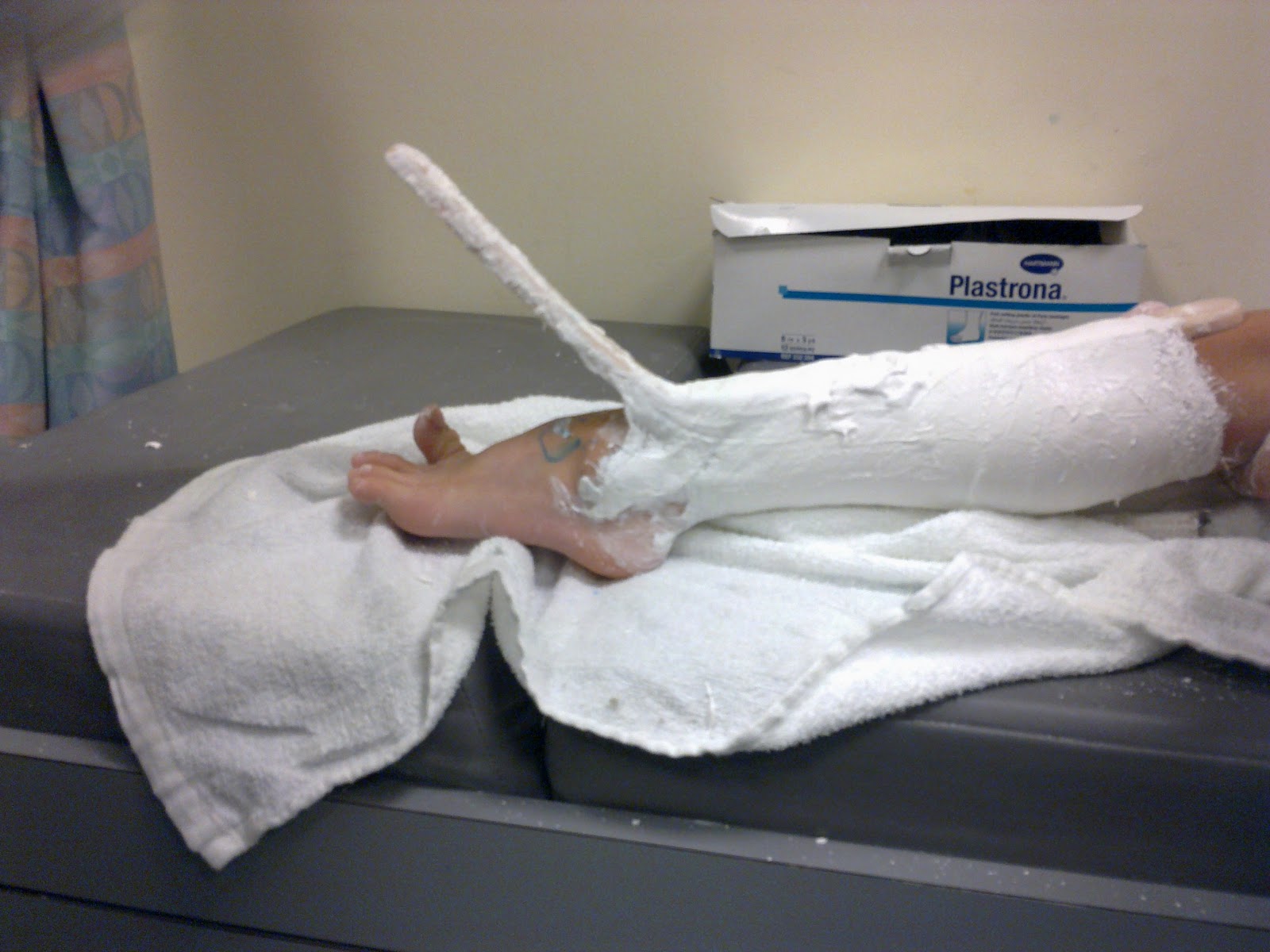 Reflect & Relate ...: AFO VERSUS SMO = AFO FITTED