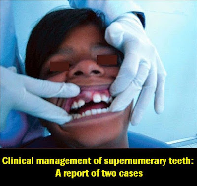 ORAL MEDICINE: Clinical management of Supernumerary Teeth: A report of ...