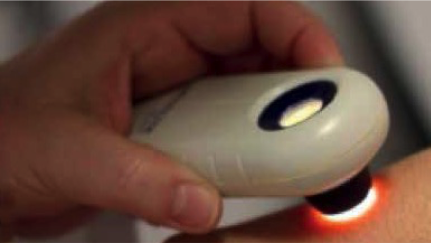 Introducción a la dermatoscopia para médicos de familia