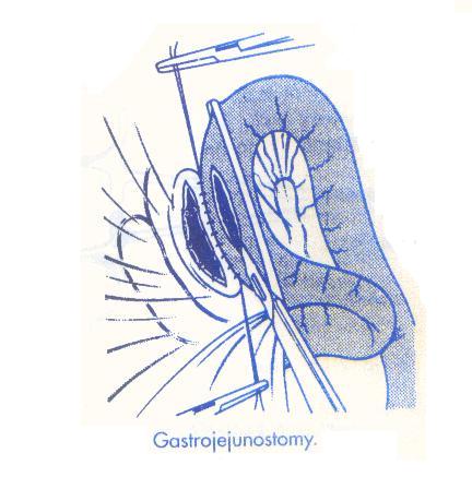 OTMANAGE: GASTRO JEJUNOSTOMY PROCEDURE 2