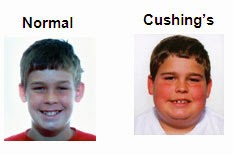 Cushing's Syndrome : Signs and symptoms of Cushing's syndrome