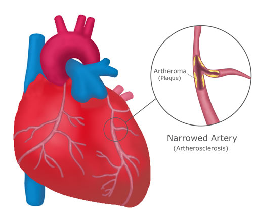 Narrowed Arteries ~ All Tutorial Site