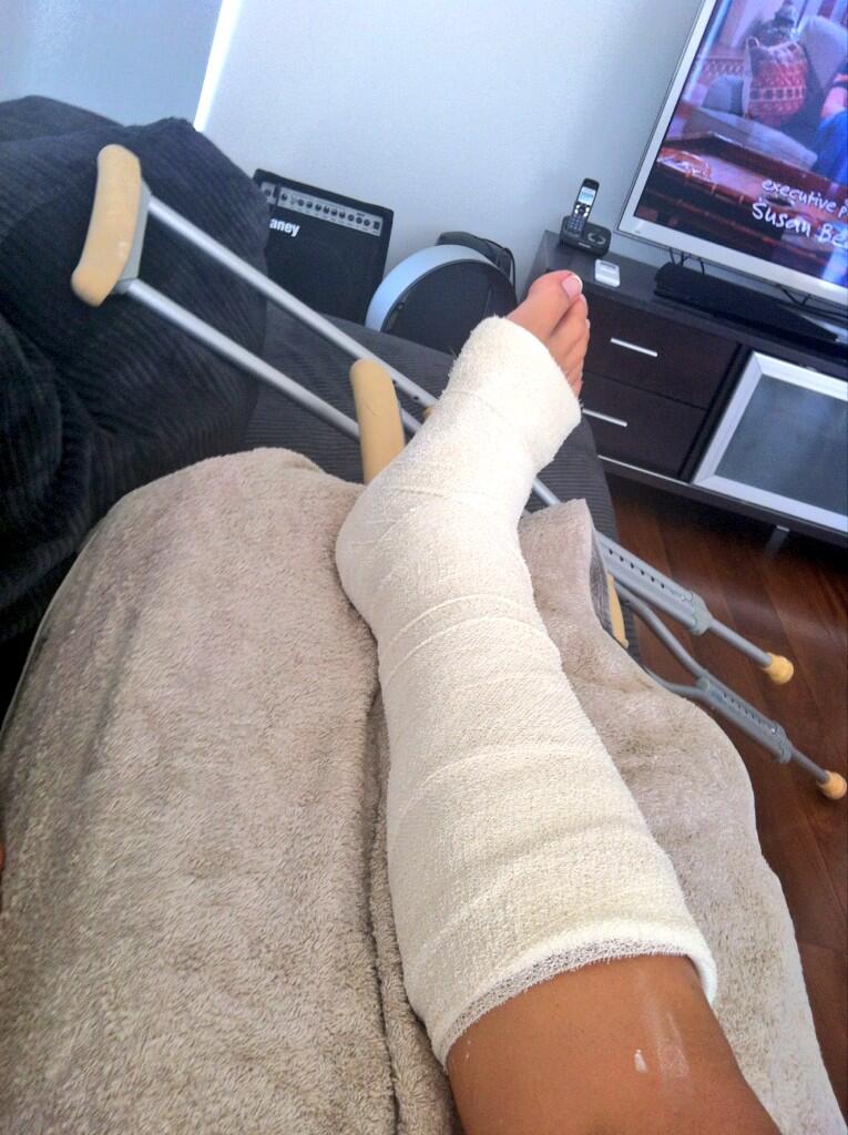 Casts and Toes: Some Short Leg Cast Pics