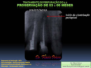 Descobrindo e explorando a Endodontia : Tratamento de Perfuração ...