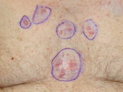 Pictures of skin cancer: Skin cancer examples