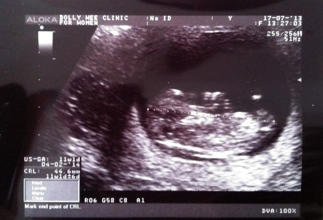 our little precious one..: 11 weeks: 2nd Prenatal Checkup