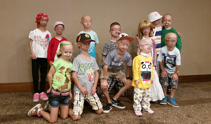 Atypical Progeria Syndrome Harry's story : Family is everything ...