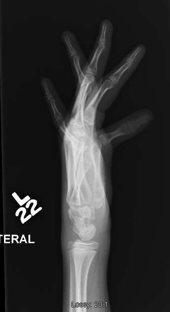 Small thumbs | Congenital Hand and Arm Differences | Washington ...