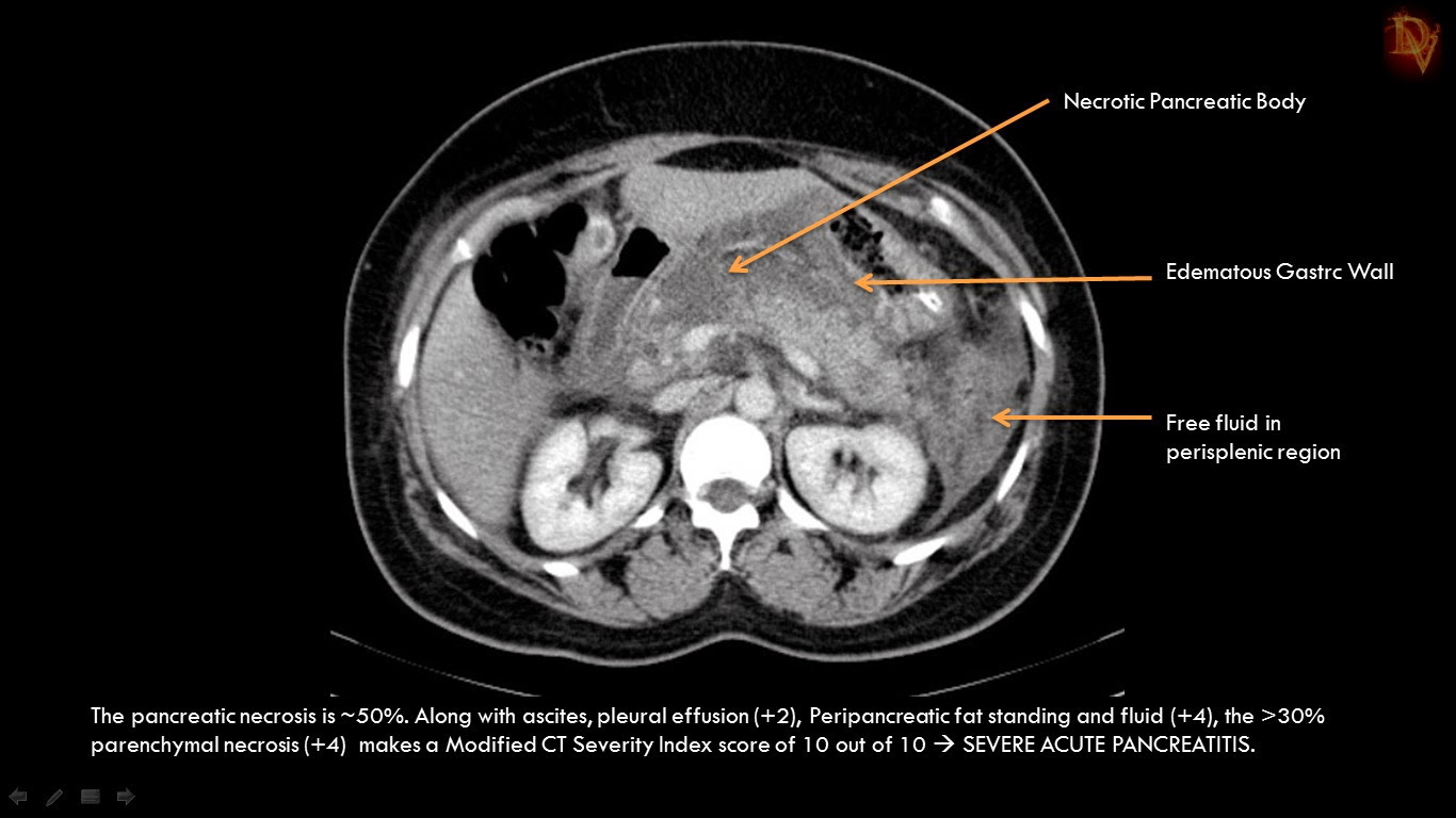 Ultimate Radiology : Acute Necrotizing Pancreatitis