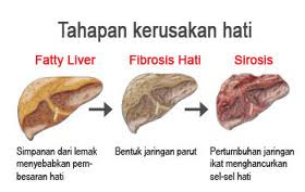 Sirosis Hati - Tisya Amanah Pramesti