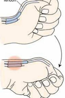 prueba de finkelstein