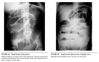 Sudiyatmo,MD Blog & Journal: Ileus Obstruksi (Obstruksi Intestinal)
