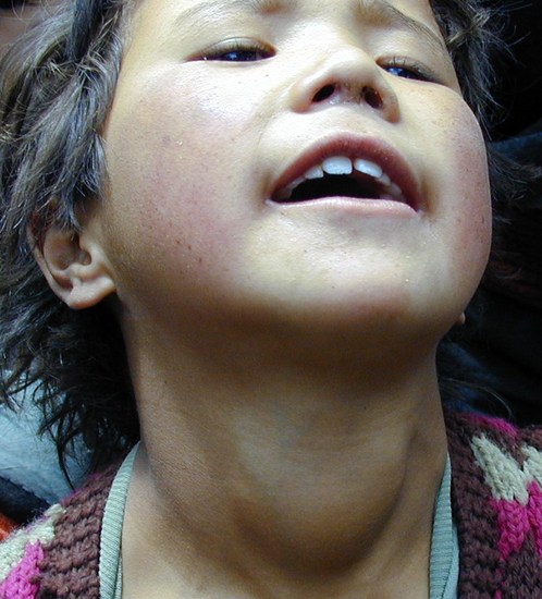 Health is Wealth: Endemic simple goitre and its prevention and control