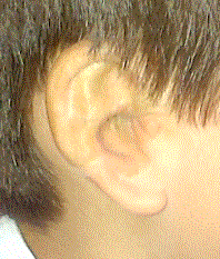 Microtia and Aural Atresia - Our Experience: Before and After Photos