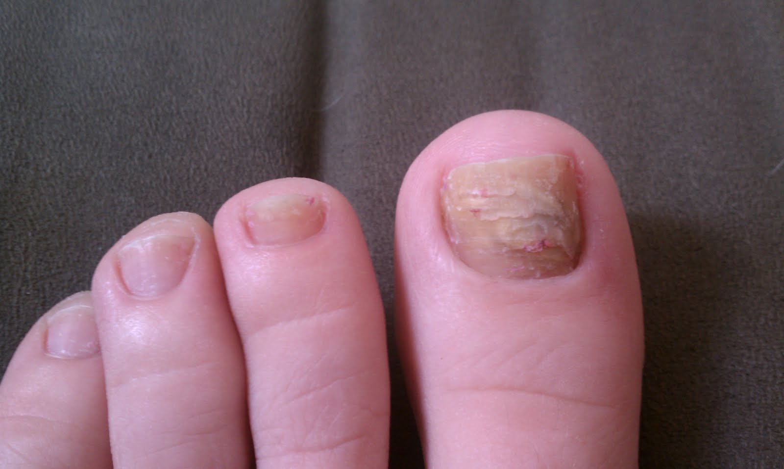 5.21.11: WARNING-Another gross toenail photo