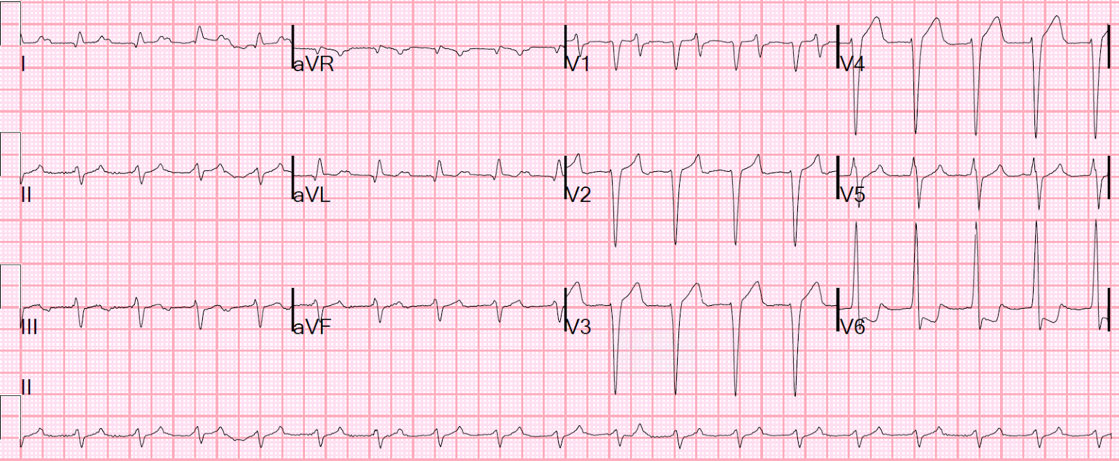 Dr. Smith's ECG Blog: ST elevation and depression: is it ischemia? The ...