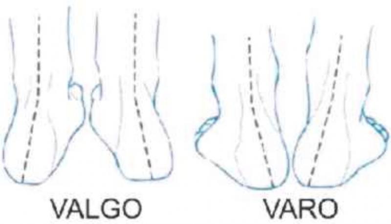 Alteraciones frecuentes en los pies de los niños – Efisiopediatric