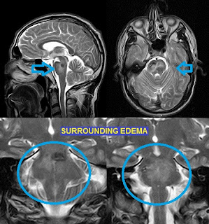 POINT OF VIEW: DX: Pontine cavernoma (deep cavernoma)