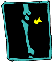 Lesiones Deportivas: marzo 2014