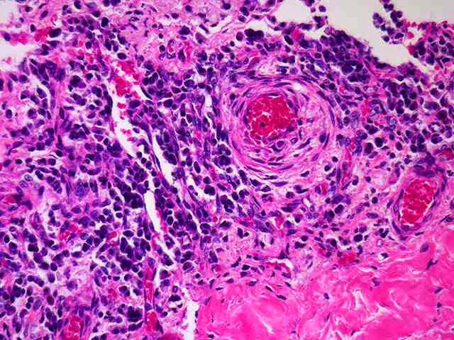 diagnosis of syphilis ~ infectious diseases