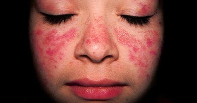 Disangka Gatal kulit biasa, rupanya SLE. Ketahui Gejala Penyakit SLE