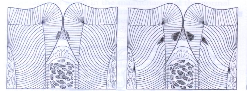 SMILE CARE: CLASSIFICATION OF DENTAL CARIES