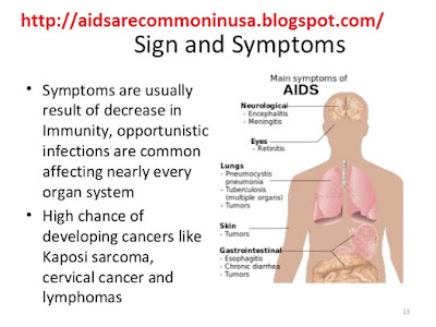 Aids are Common in USA: Aids Sign Symptoms