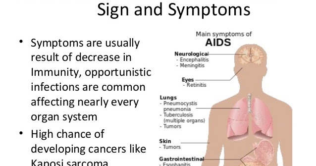 Aids are Common in USA: Aids Sign Symptoms