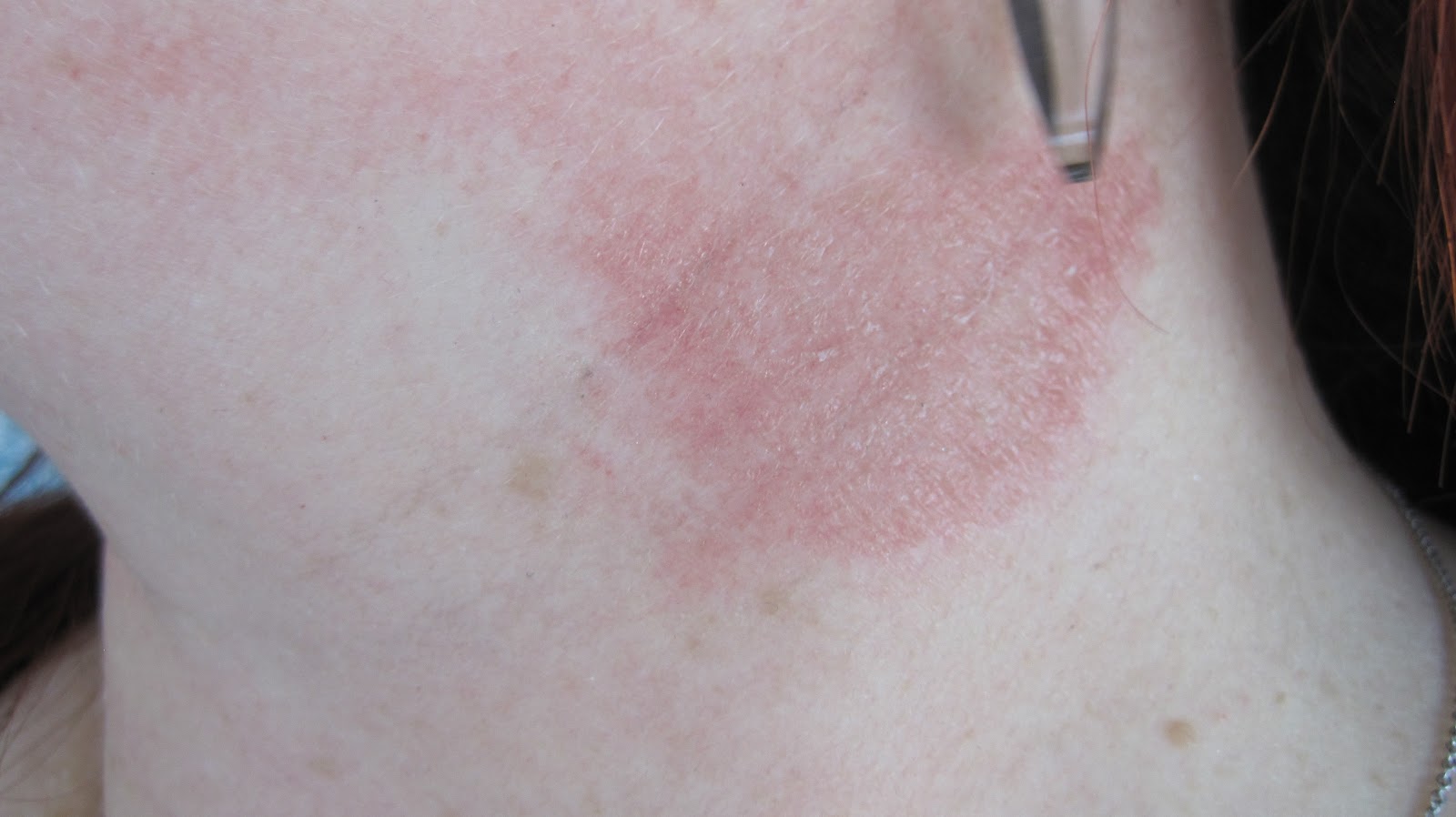 What To Put On Baby Eye Rash at Tracy Jacoby blog