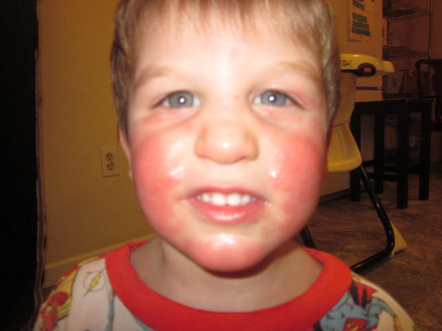 fourkidstinyhouse: Cinnamon Allergy- I believe in you